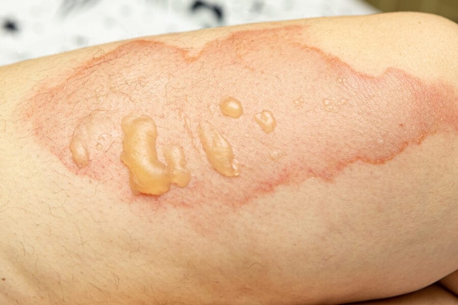 Turf Burn: Causes, Symptoms, Treatment, Prevention and How to Treat at ...